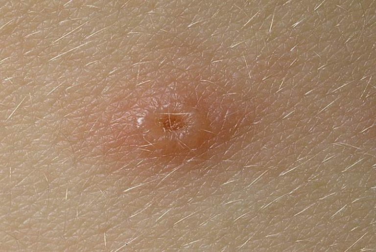 Pictures Of Early Chicken Pox Symptoms And Pictures