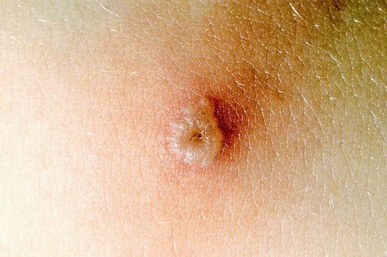 Chicken Pox Macule Stage