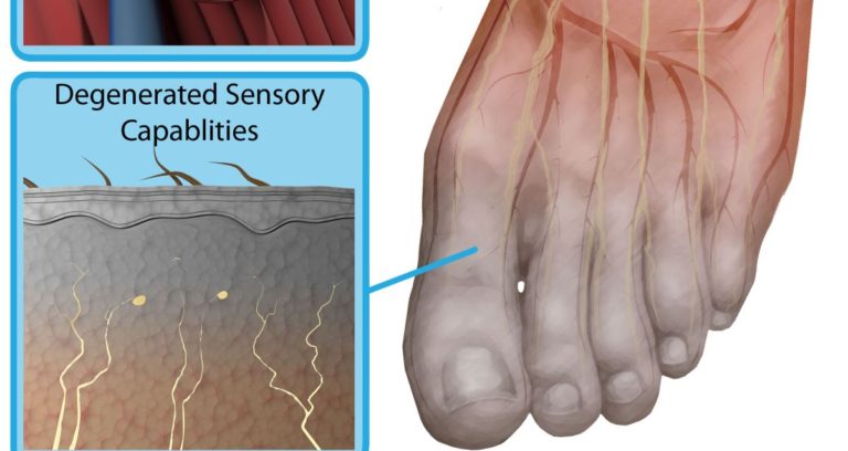 Diabetic neuropathy feet pictures | Symptoms and pictures