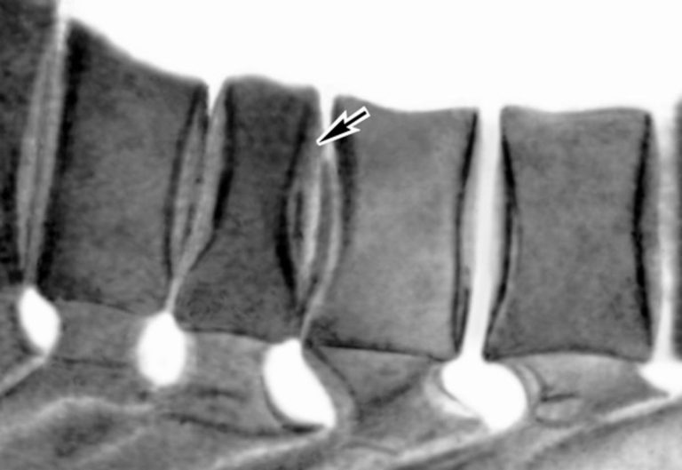 Spinal osteochondrosis pictures | Symptoms and pictures