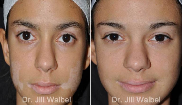 Treatment of vitiligo pictures | Symptoms and pictures