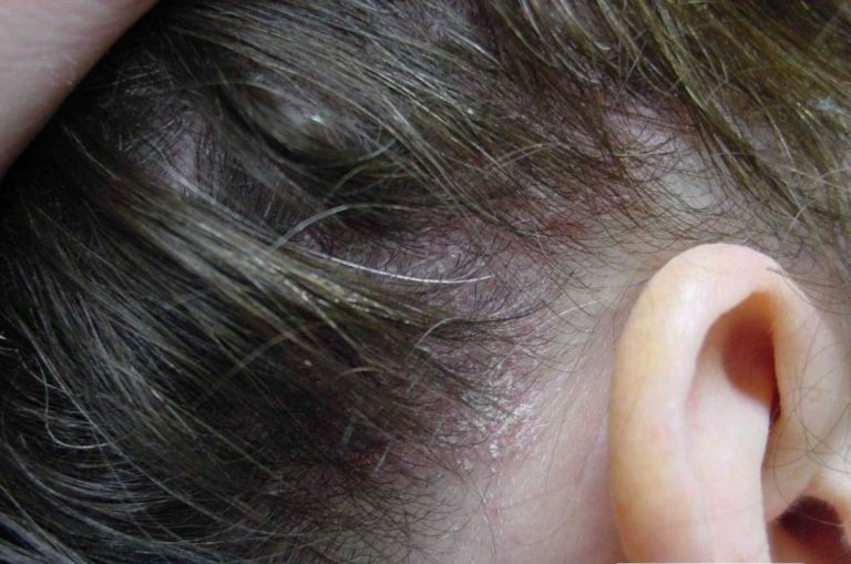 Mild psoriasis pictures | Symptoms and pictures