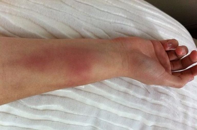 Signs of blood clot in arm pictures | Symptoms and pictures