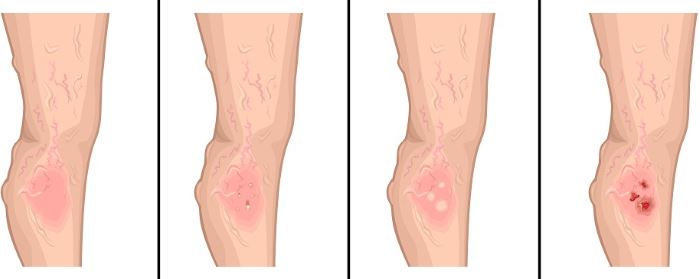Venous Leg Ulcer Pictures Venous Skin Ulcer Pictures Leg Sores 