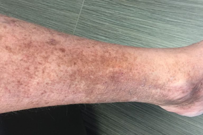 Symptoms of venous stasis dermatitis pictures | Symptoms and pictures