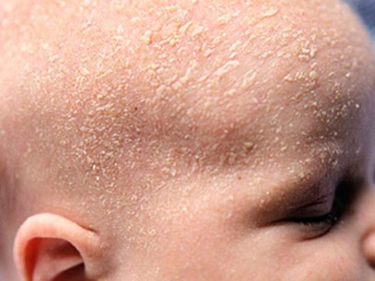 Seborrheic dermatitis in children pictures | Symptoms and pictures