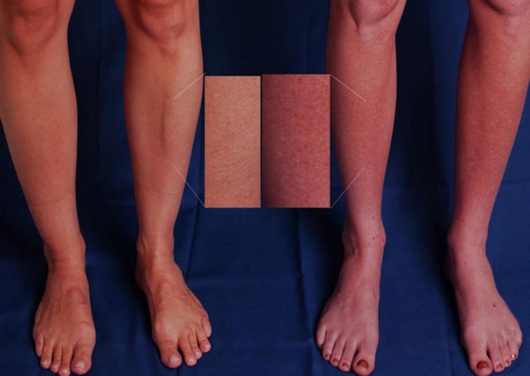 Dermatitis on legs pictures | Symptoms and pictures