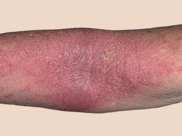 Dermatitis on arms pictures | Symptoms and pictures