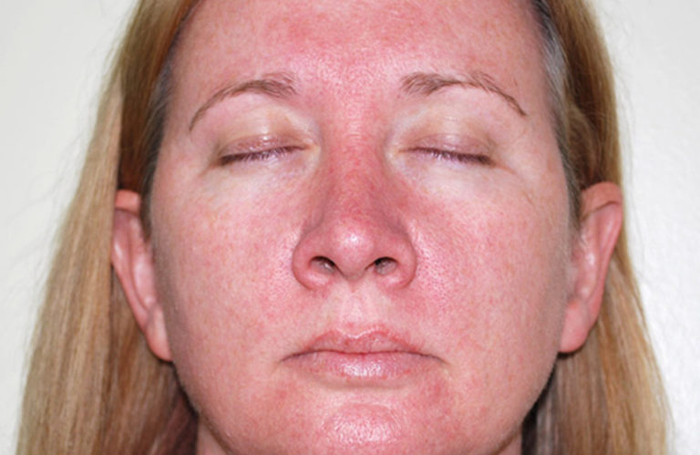 Photodermatitis images | Symptoms and pictures