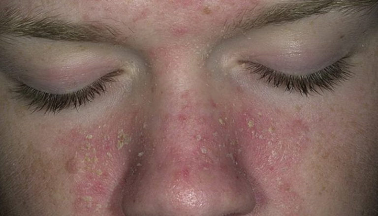 Seborrheic dermatitis face pictures | Symptoms and pictures