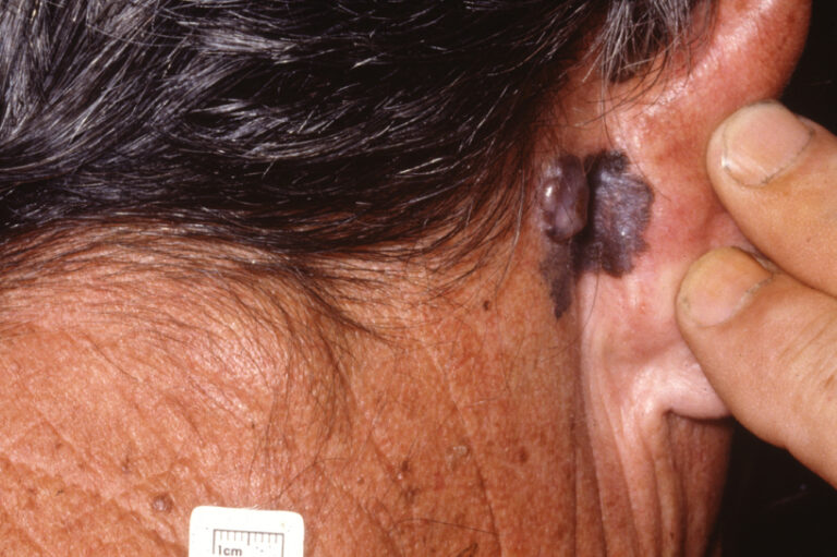 Ear melanoma pictures 2 | Symptoms and pictures
