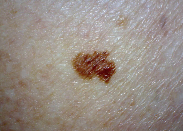 Early stage melanoma cancer pictures | Symptoms and pictures