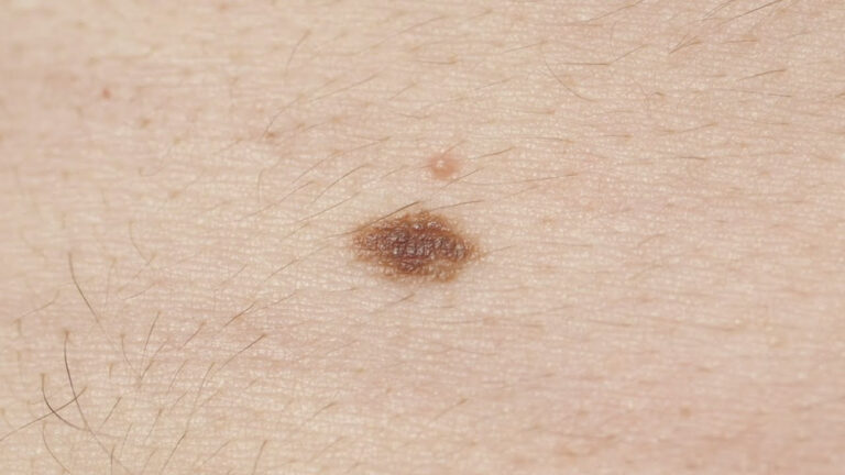 Melanoma cancer pictures stage 1 | Symptoms and pictures