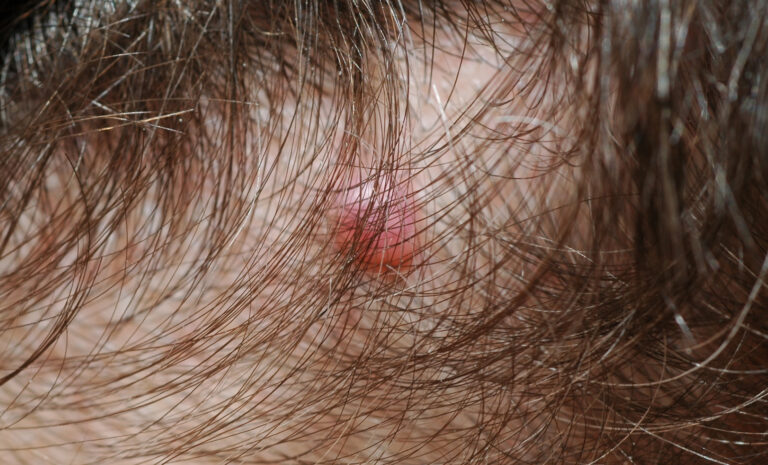 Melanoma pictures on head | Symptoms and pictures
