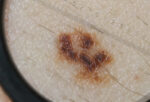 Melanoma pictures by stages, stage 0-1-2-3-4 melanoma pictures ...