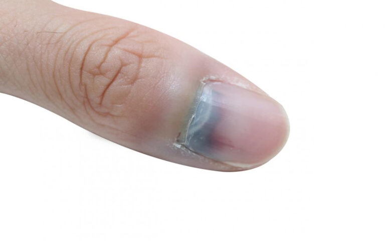 images of toenail cancer | Symptoms and pictures