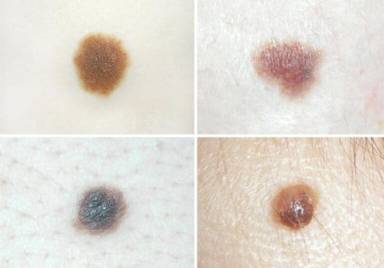 moles that are cancerous images | Symptoms and pictures