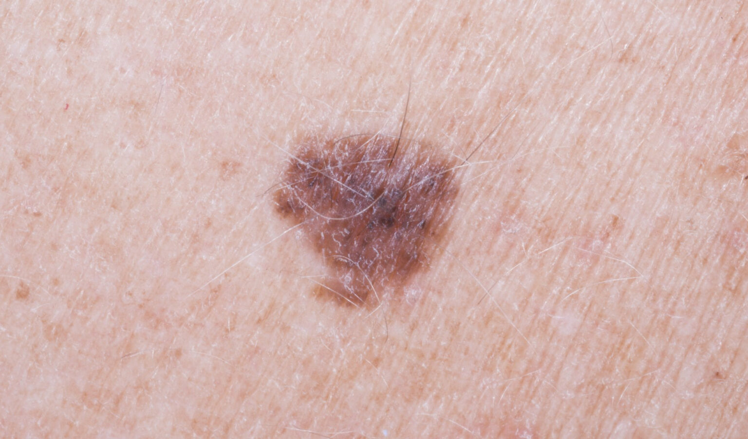 pictures of cancerous moles nhs | Symptoms and pictures
