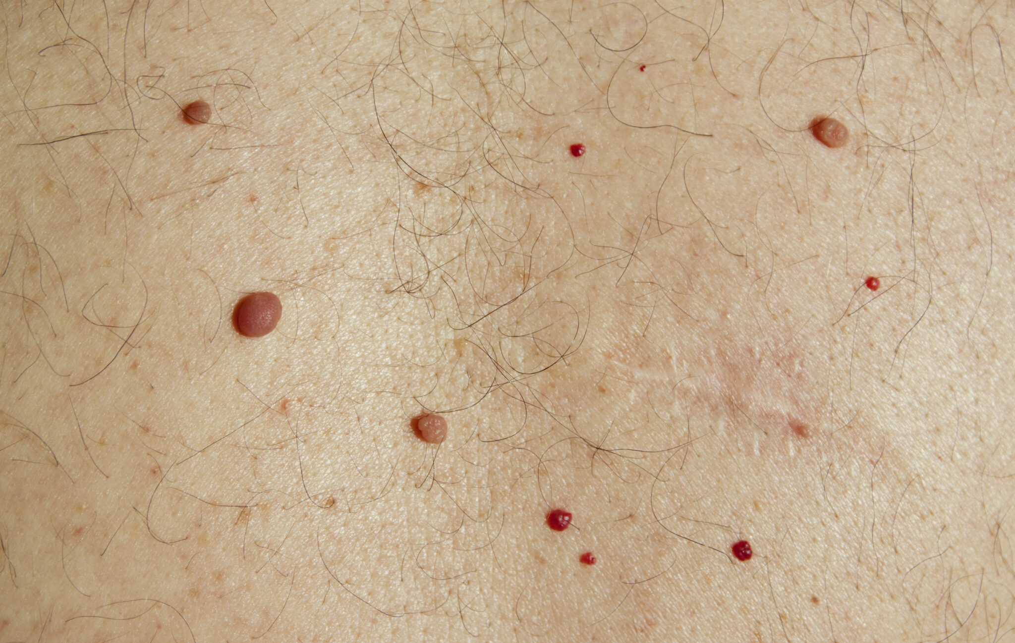 red mole cancer images | Symptoms and pictures