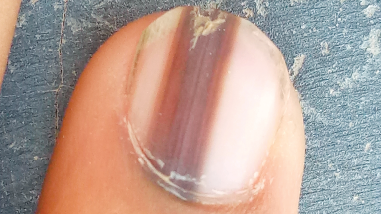subungual melanoma toenail pictures | Symptoms and pictures