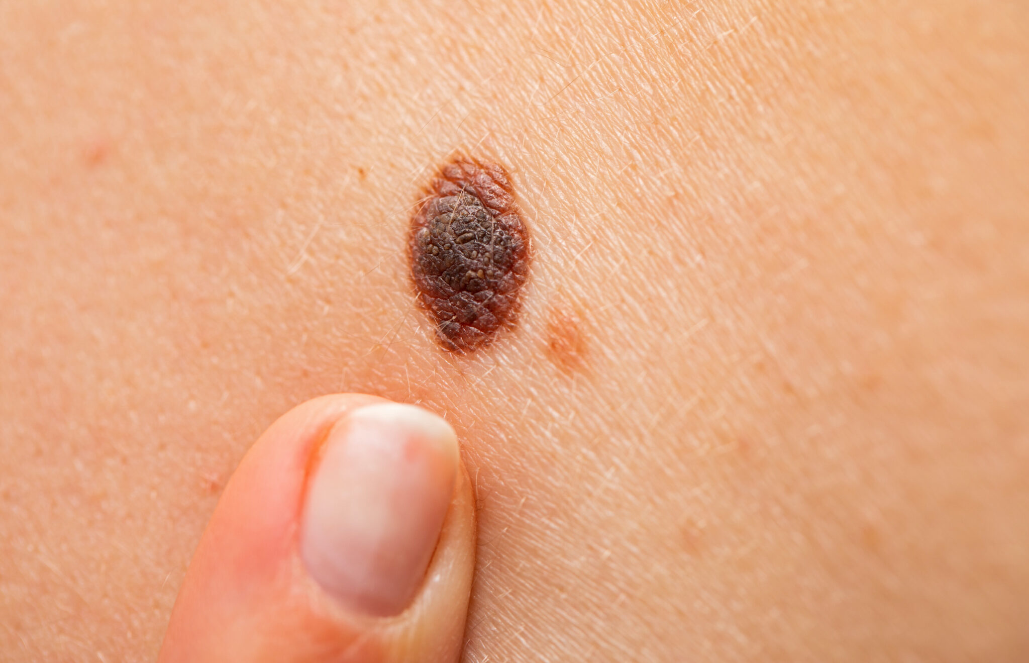 Pictures of cancerous moles: early stage, cancerous moles images ...
