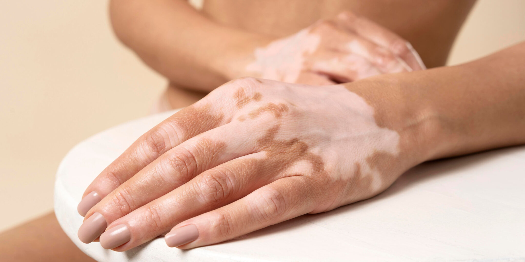 What Does Vitiligo Look Like? Pictures of Vitiligo, Early Signs ...