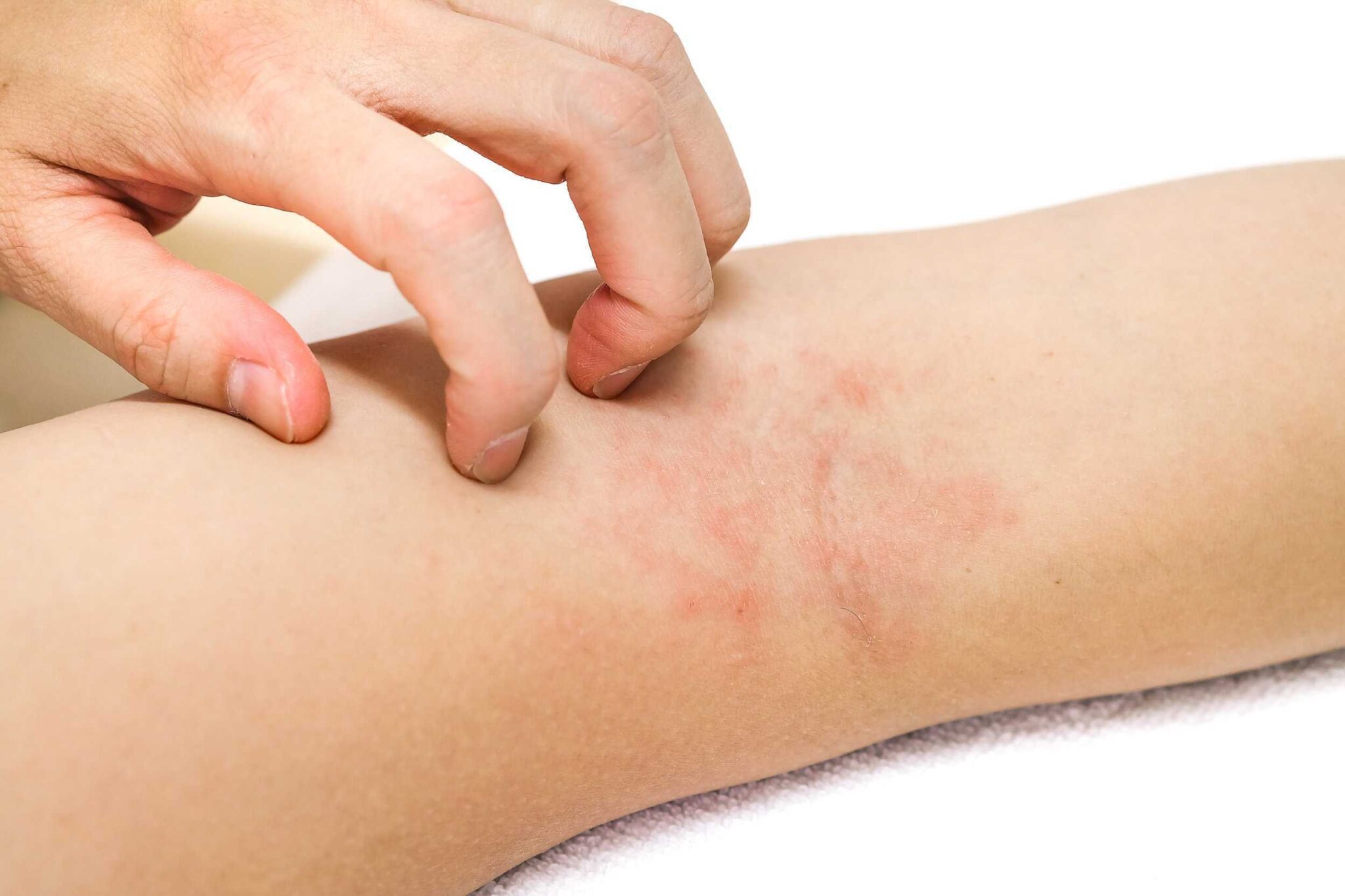 What Does Eczema Look Like Symptoms Pictures