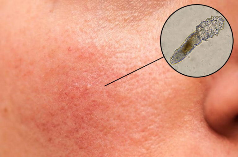 What does Demodicosis look like symptoms pictures